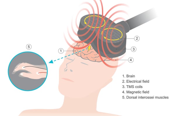 Medical Devices Offer New Opportunities to Alleviate Symptoms of PWS